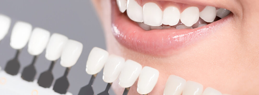 El color de los dientes ¿ de qué depende? -canalSALUD