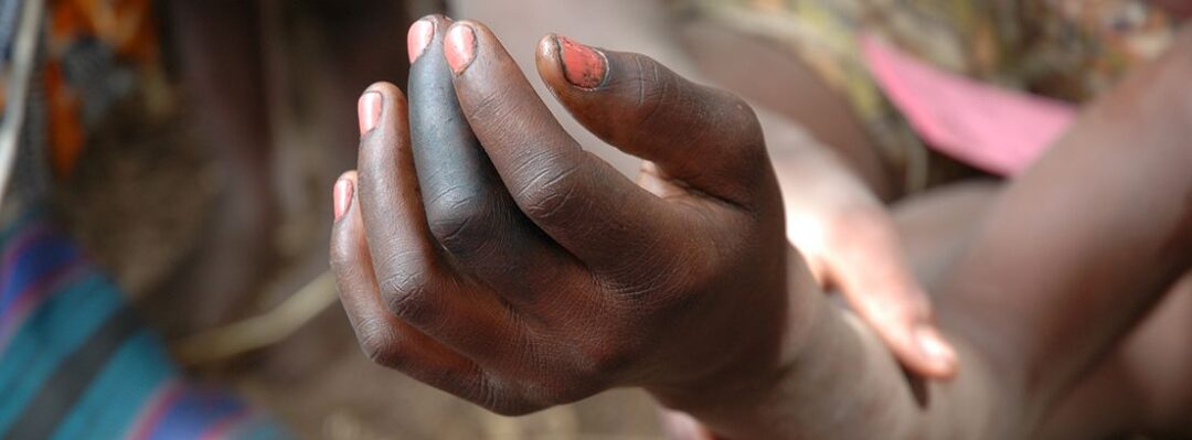 ¿Qué es la gangrena y cuáles son las causas? -canal SALUD