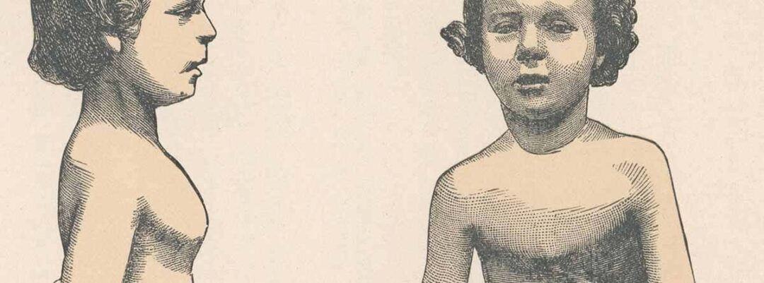 Pectus carinatum, ¿qué es? - Blogs MAPFRE