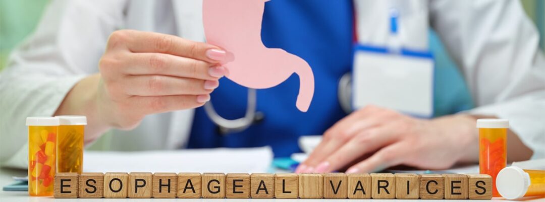 Varices esofágicas: causas y tratamiento - Blogs MAPFRE